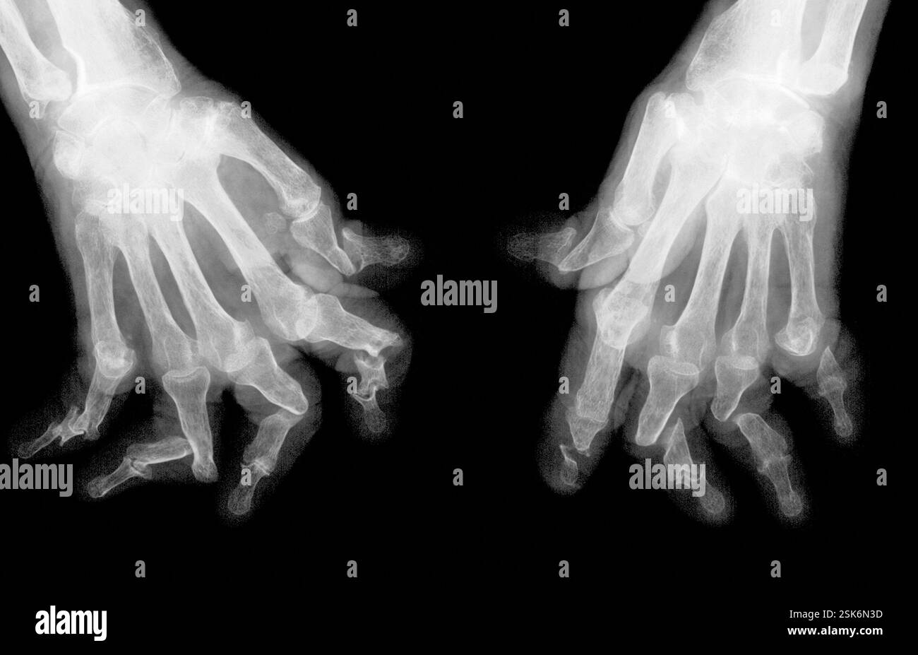 Psoriatic arthritis of the hands, X-ray. Psoriatic arthritis occurs in ...