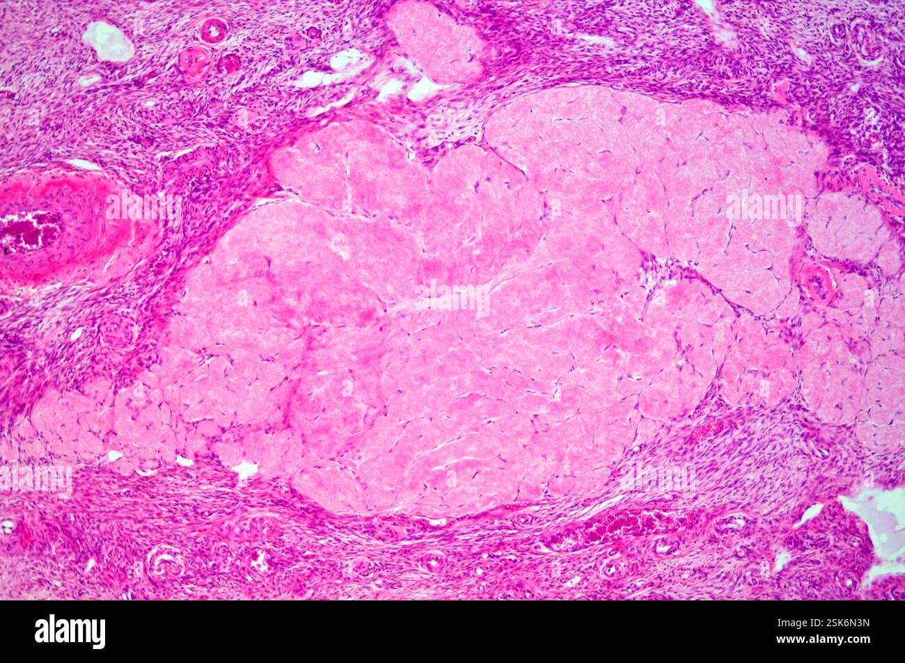 Corpus albicans. Light micrograph of a section through a human ovary ...