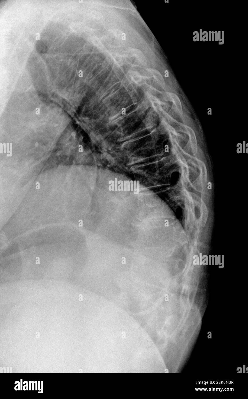 Curved spine. X-ray of a patient with kyphosis (curvature of the spine ...