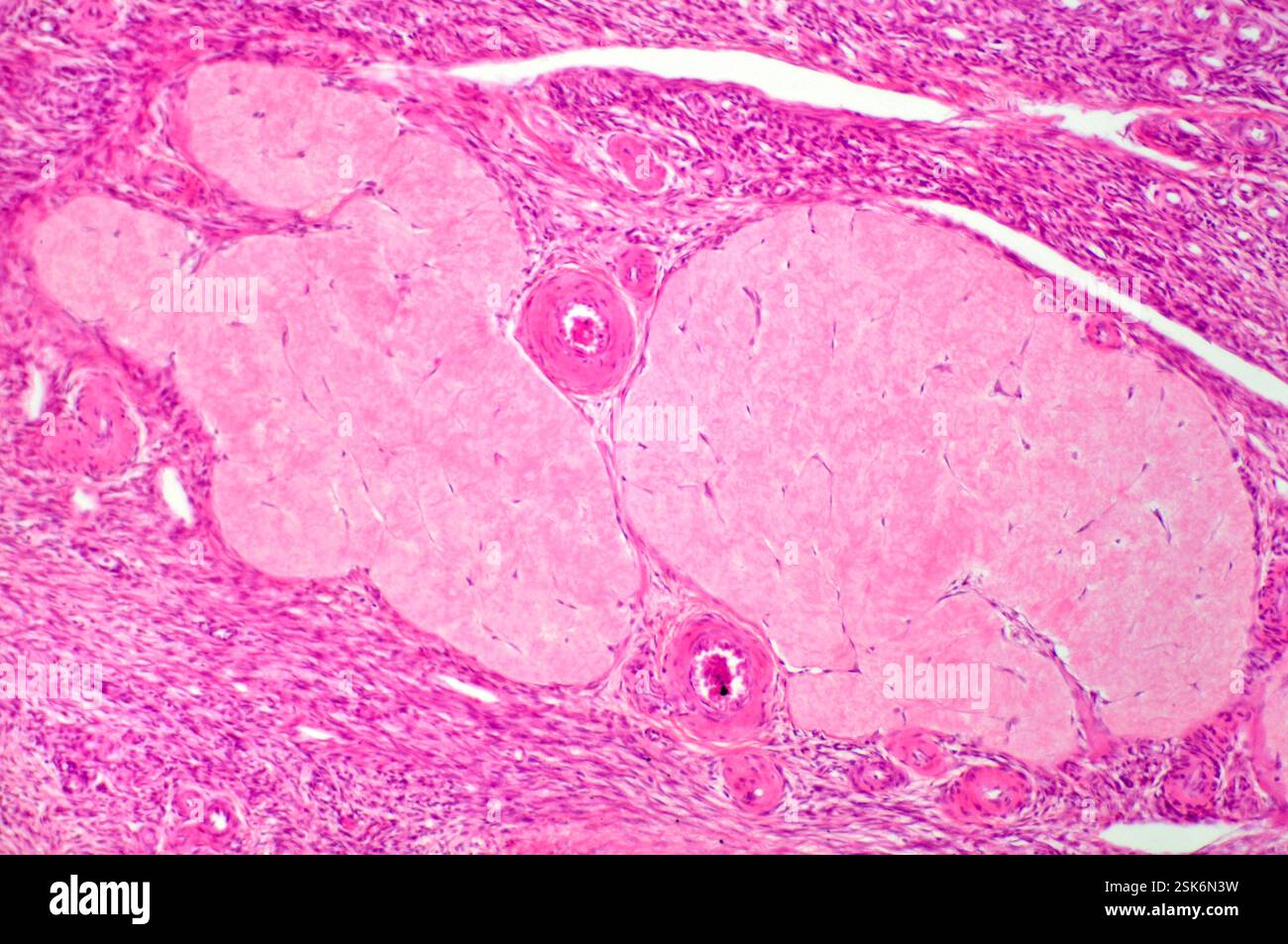 Corpus albicans. Light micrograph of a section through a human ovary ...