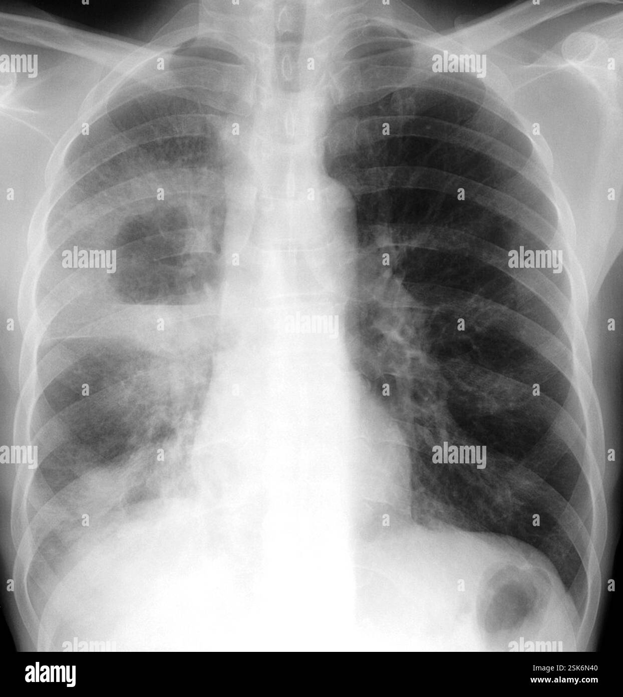Lung abscess. X-ray of the chest of a patient showing an abscess ...