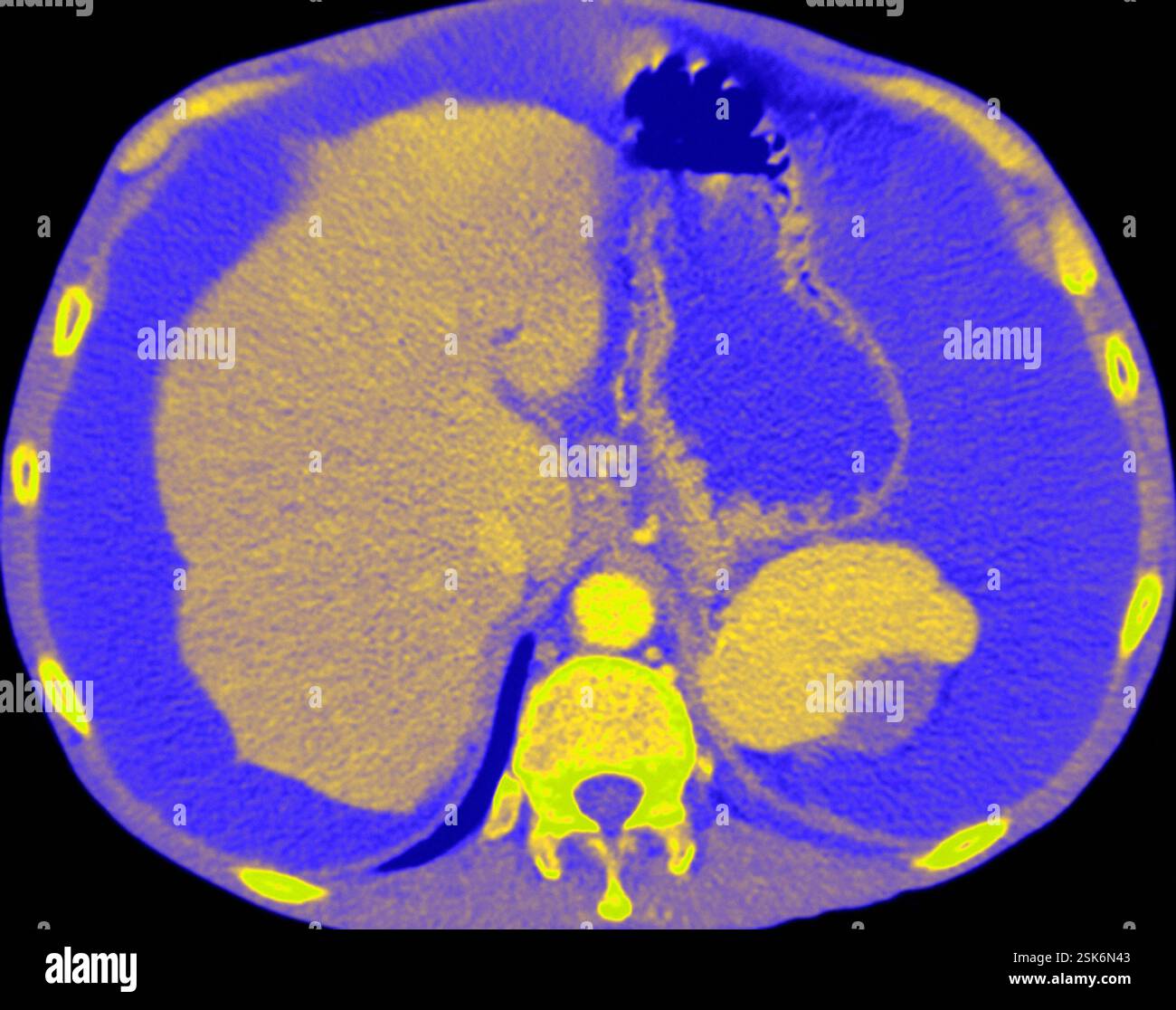 Ascites of the liver. Coloured computed tomography (CT) scan of the ...
