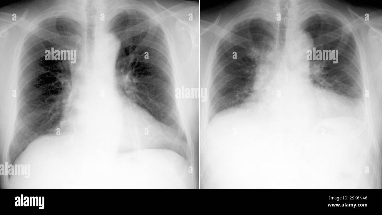 Healthy lungs. Frontal chest X-rays showing a young man's lungs during ...