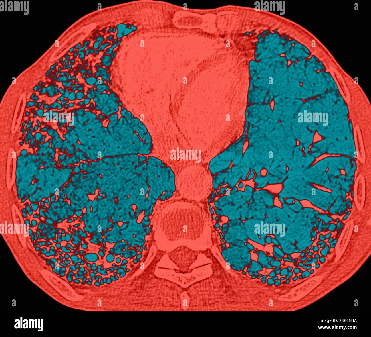 Fibrosing alveolitis. Coloured computed tomography scan of the chest of ...