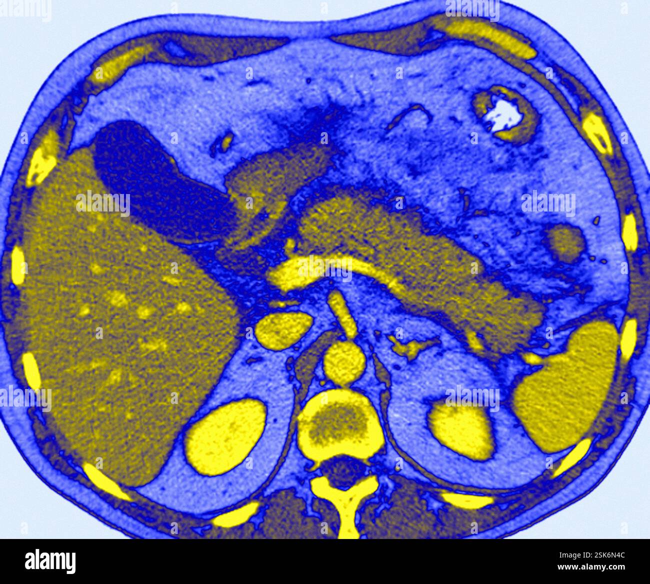 Pancreatitis. Coloured computed tomography (CT) scan of a section through the abdomen of a ...
