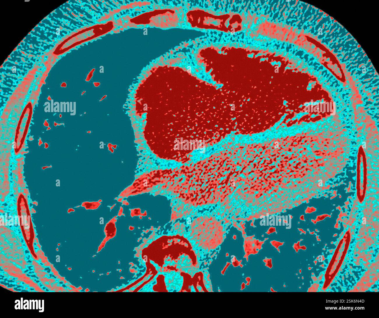 Cardiomegaly. Coloured computed tomography (CT) scan of an axial ...