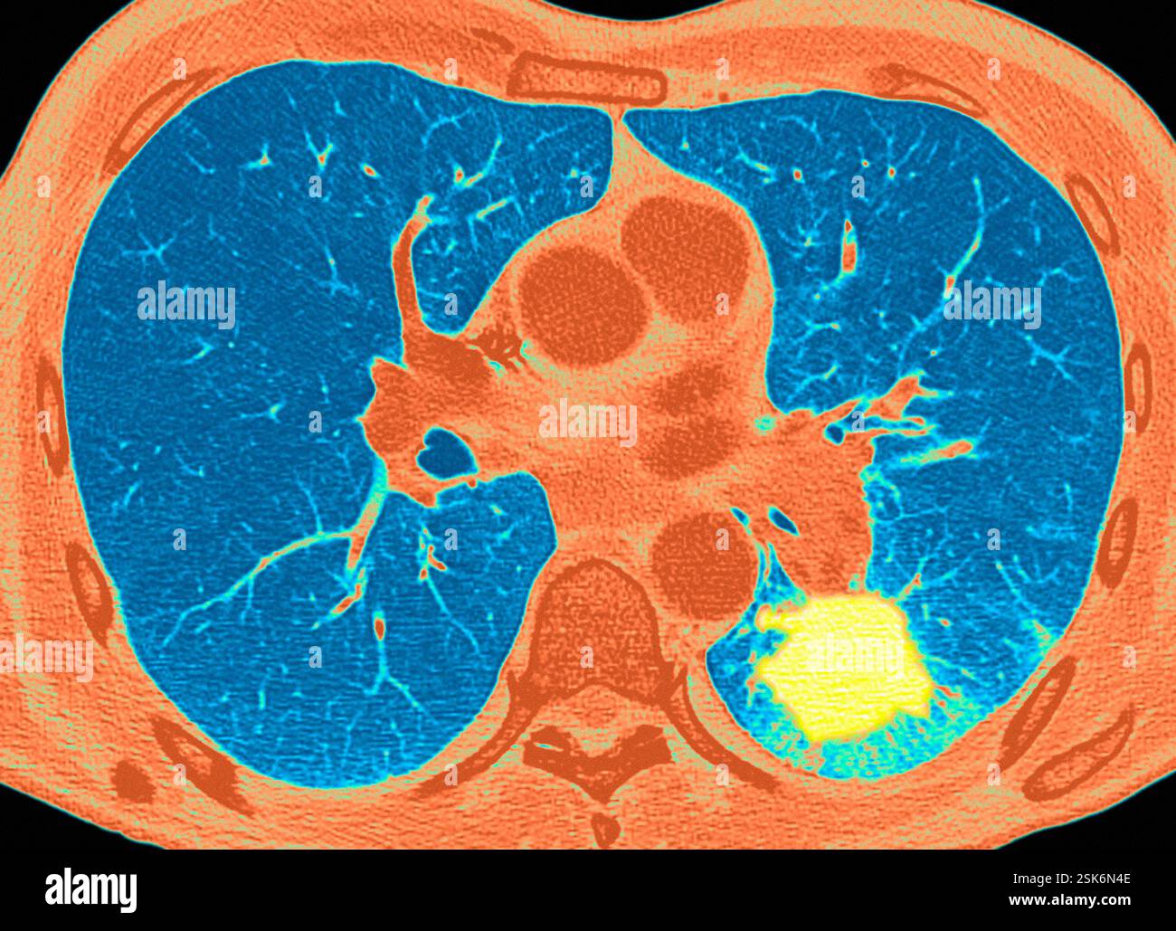 Lung cancer. Coloured computed tomography (CT) scan of the chest of a male patient with ...