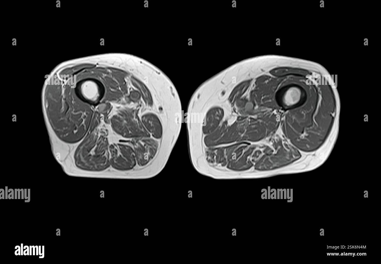 Thighs. Magnetic resonance imaging (MRI) scan of an axial section (from above) through the ...
