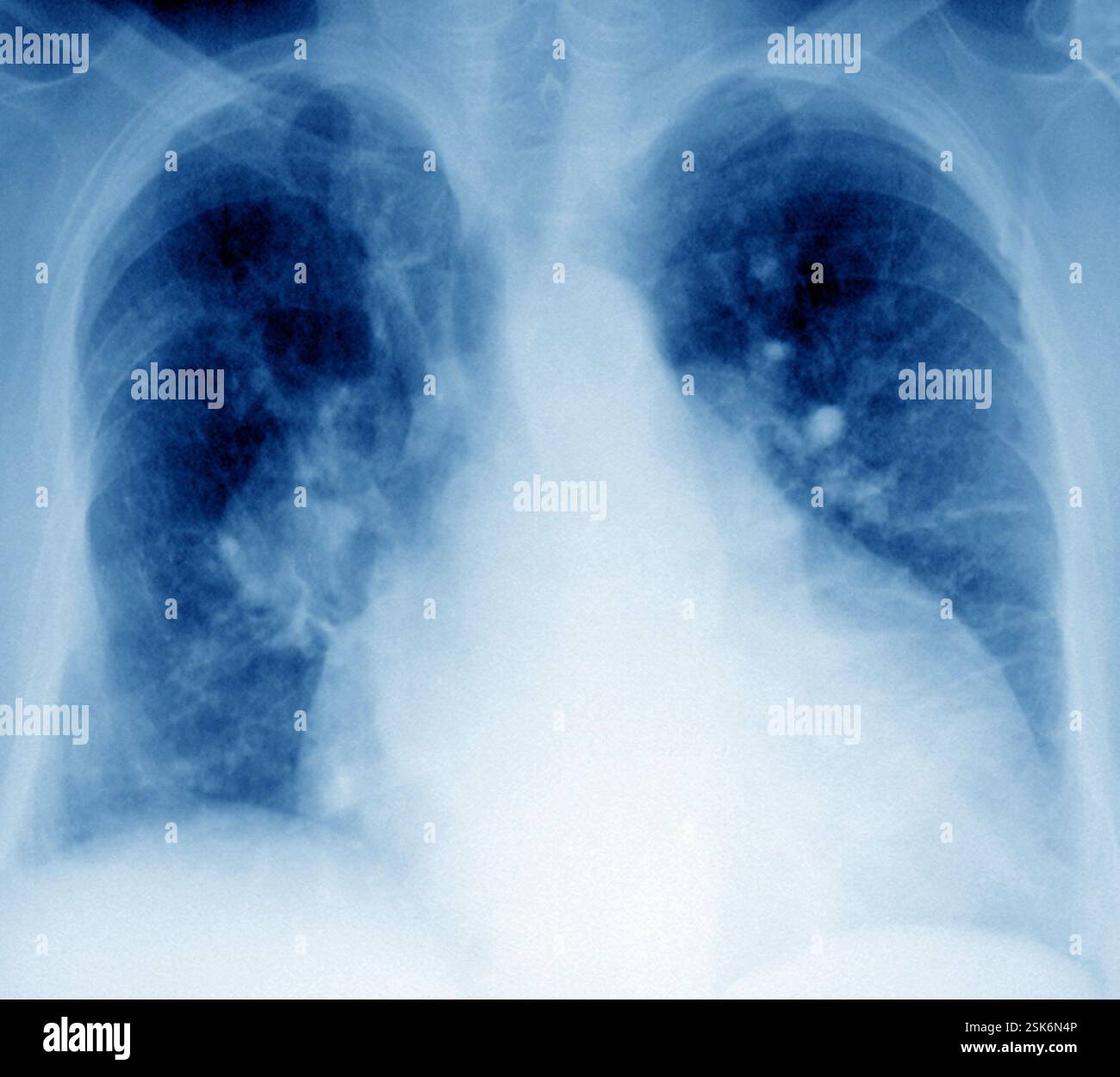Cardiomegaly. Coloured frontal X-ray of the chest of a patient with ...