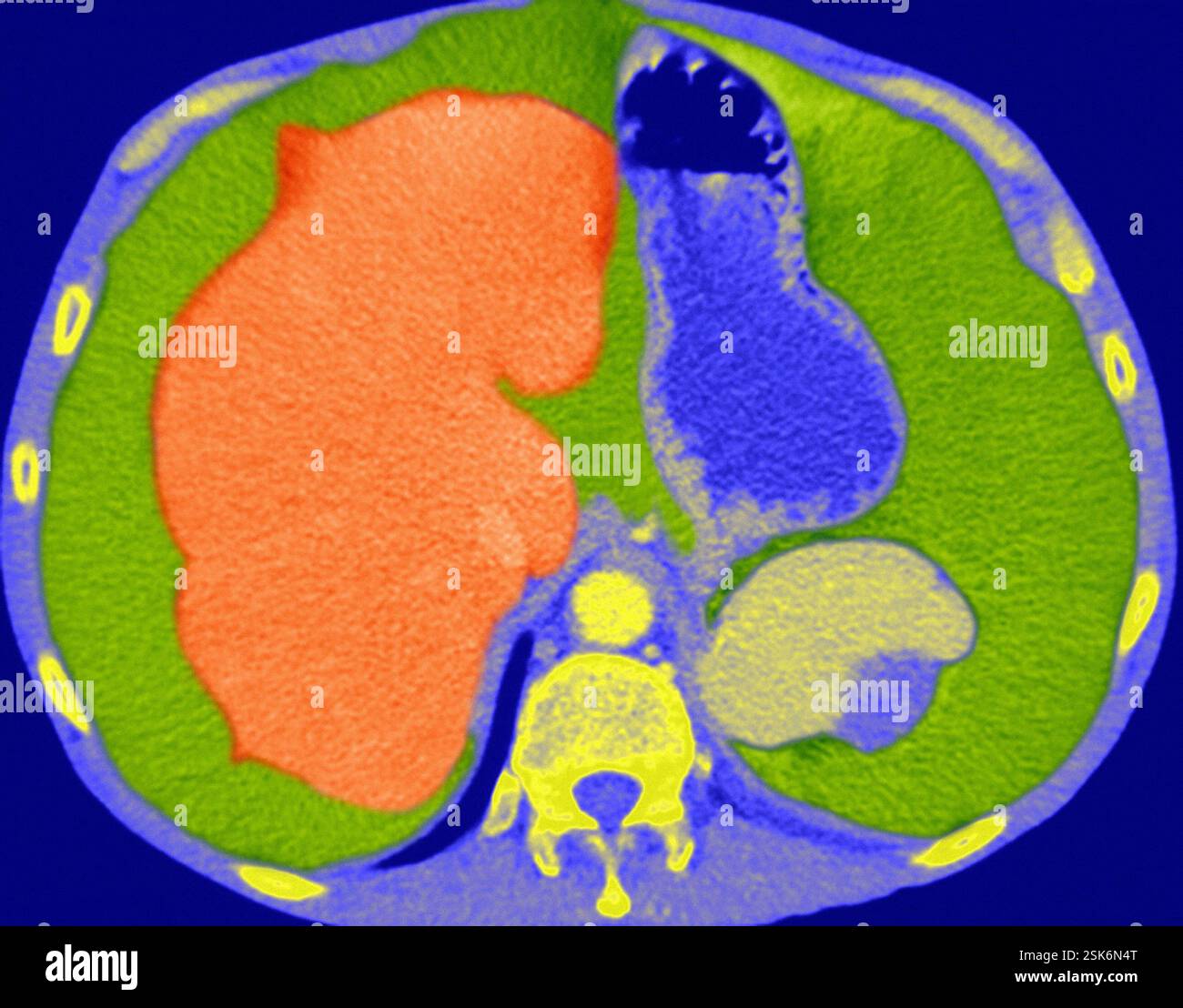 Ascites of the liver. Coloured computed tomography (CT) scan of the ...