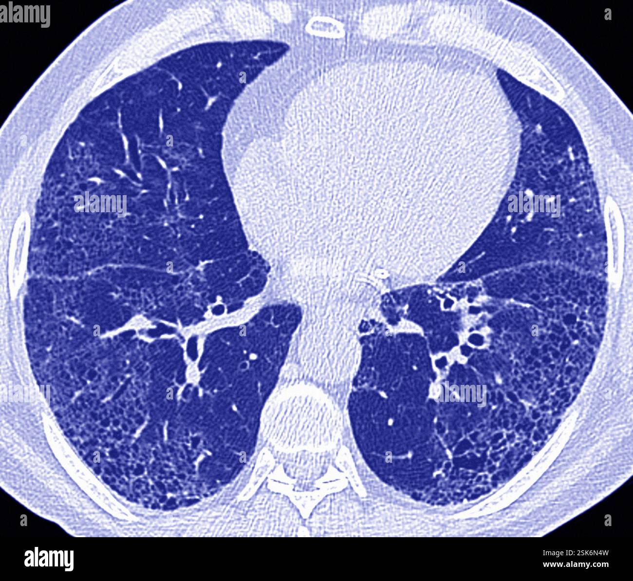 Fibrosing alveolitis. Coloured computed tomography scan of the chest of ...