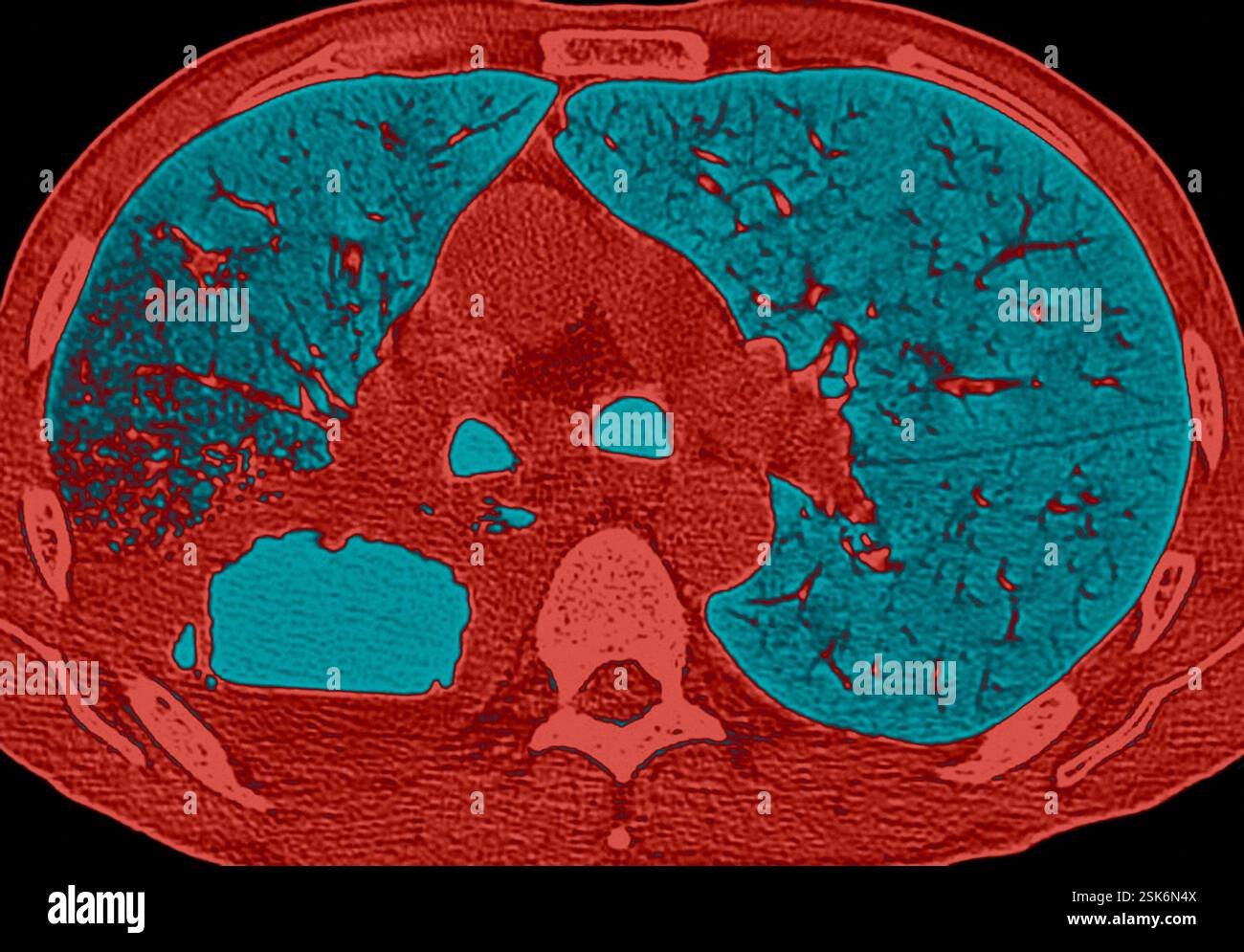 Lung abscess. Coloured computed tomography (CT) scan of the chest of a ...