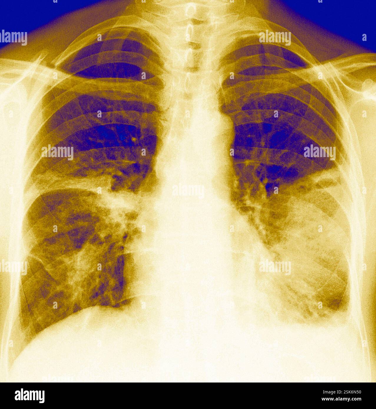 Pneumonia. X-ray of the chest of a patient with pneumonia (grainy areas ...
