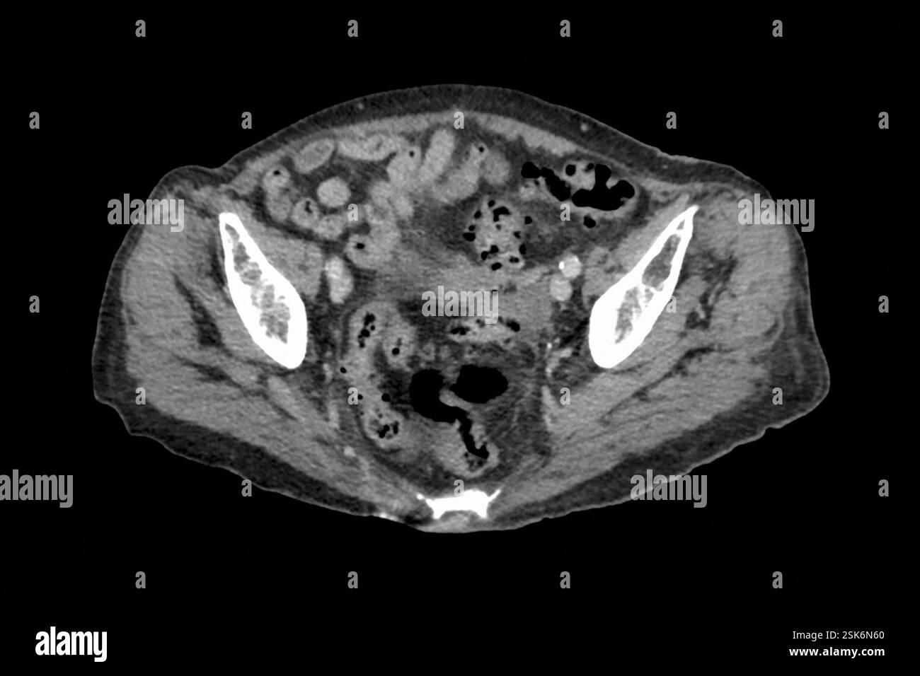 Diverticulosis. Axial computed tomography (CT) scan of the abdomen of a ...