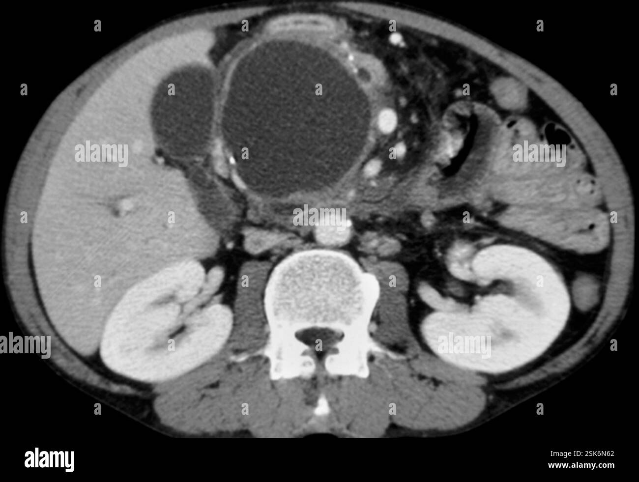 Pancreatic pseudocyst. Computed tomography (CT) scan of a section ...