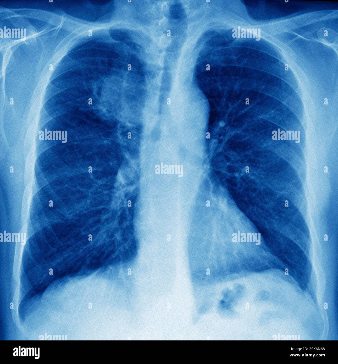 Lung cancer. Coloured frontal X-ray of the chest of a male patient with ...
