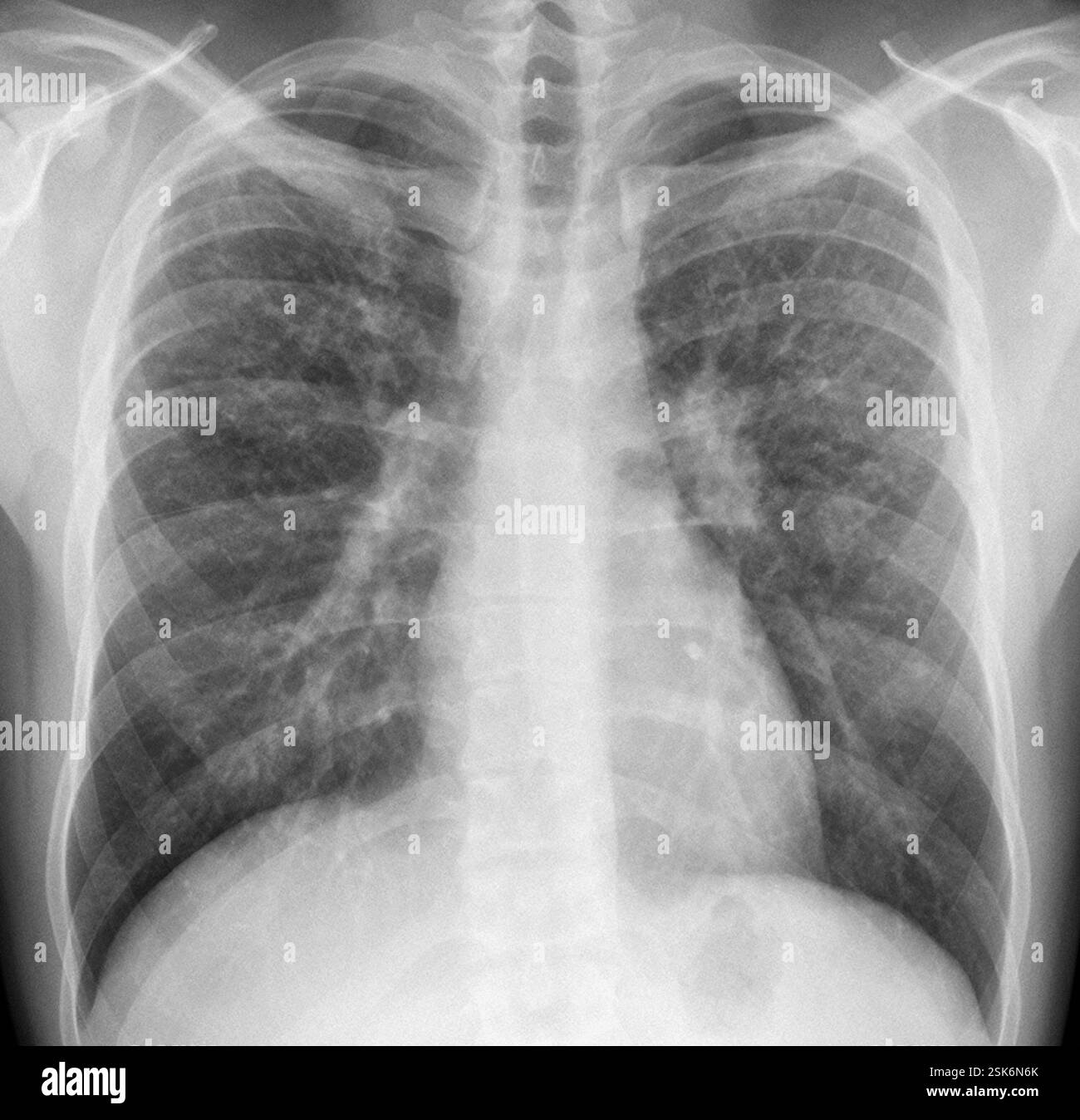 Pulmonary sarcoidosis. Frontal X-ray of the chest of male a patient ...