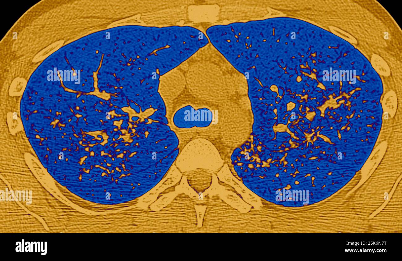 Pulmonary sarcoidosis. Coloured axial computed tomography (CT) scan of ...