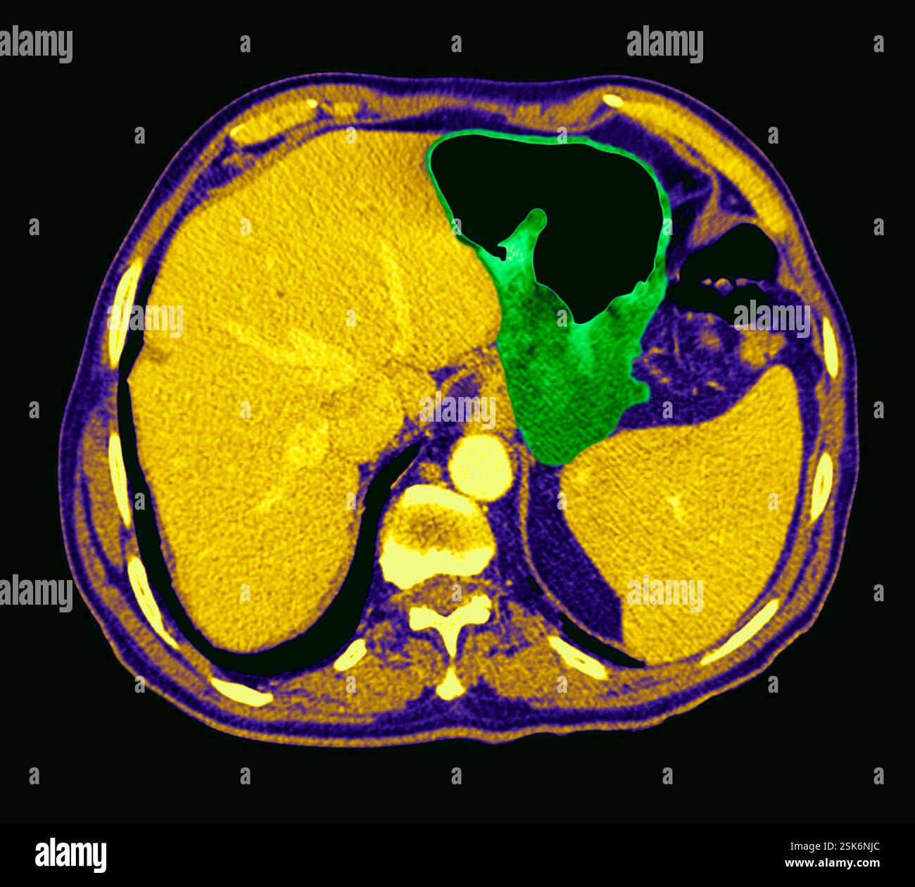 Stomach cancer. Coloured axial computed tomography (CT) scan of the abdomen of a patient with an ...