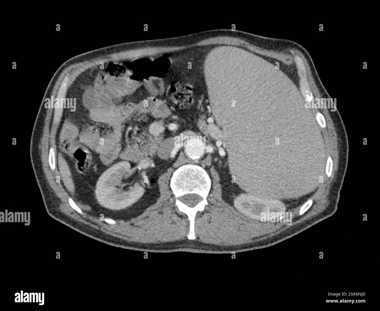 Splenomegaly. Axial computed tomography (CT) scan of the abdomen of a ...
