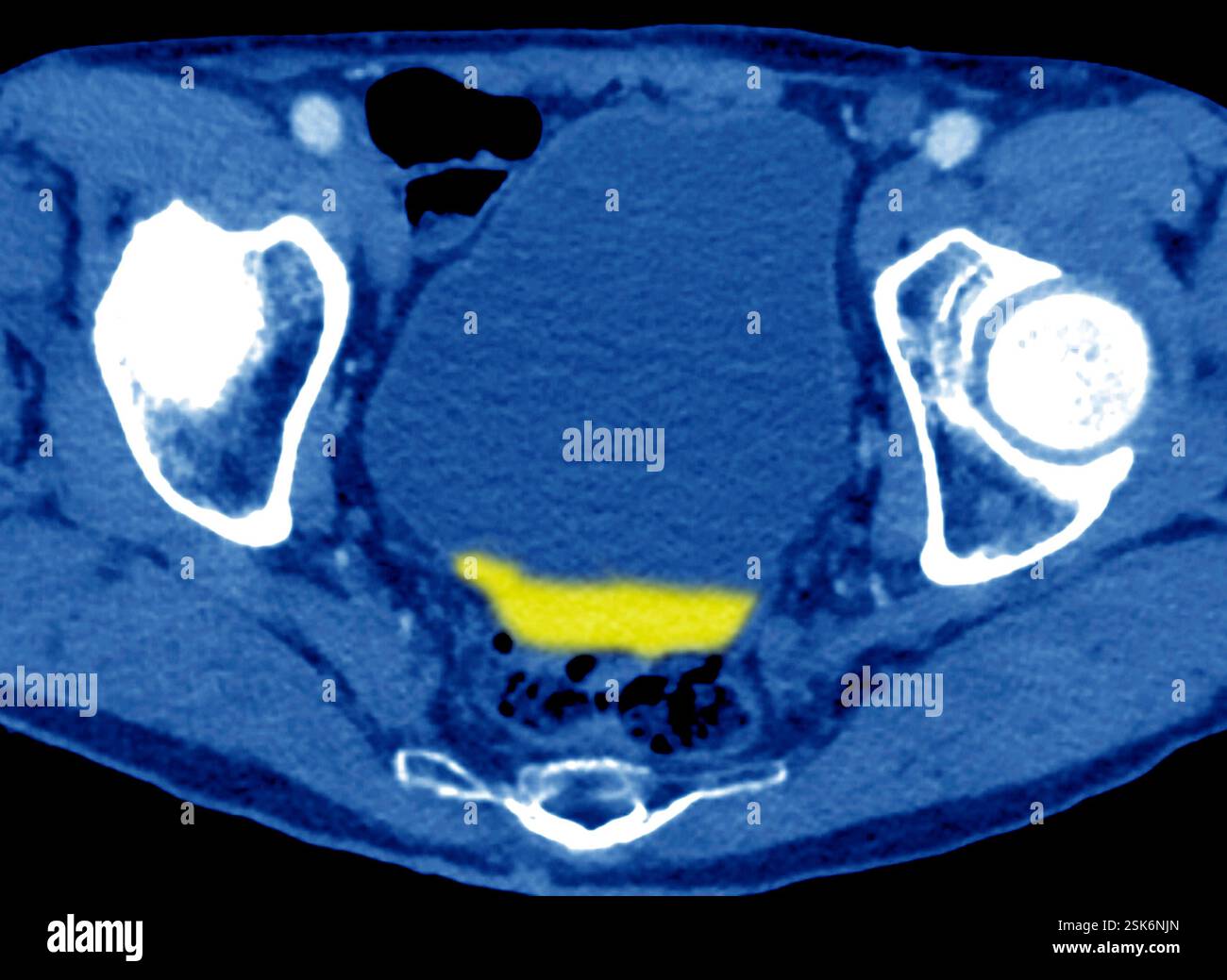 Bladder cancer. Coloured axial computed tomography (CT) scan of the ...