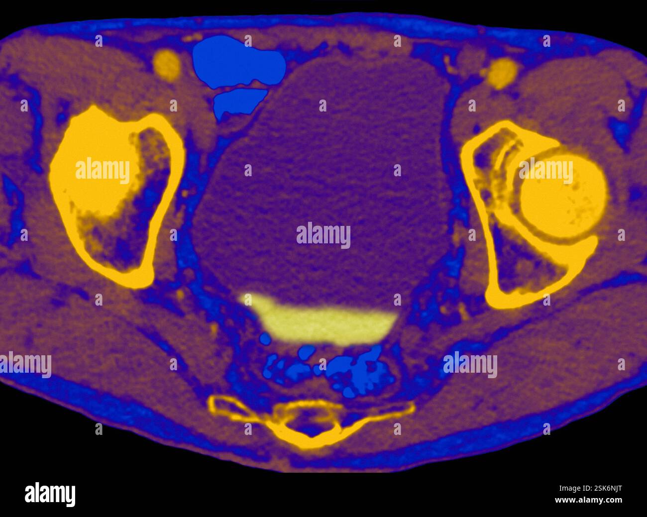 Bladder cancer. Coloured axial computed tomography (CT) scan of the pelvis of a patient with ...