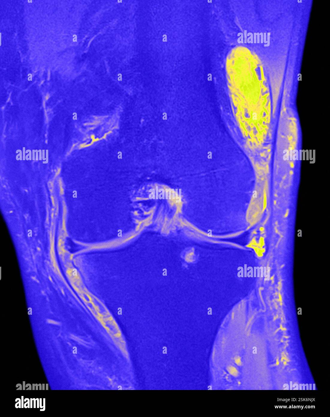 Infected knee joint. Coloured magnetic resonance imaging (MRI) scan of ...