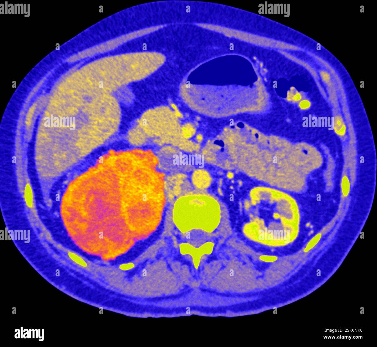 Kidney cancer. Coloured axial computed tomography (CT) scan of the abdomen of a patient with ...