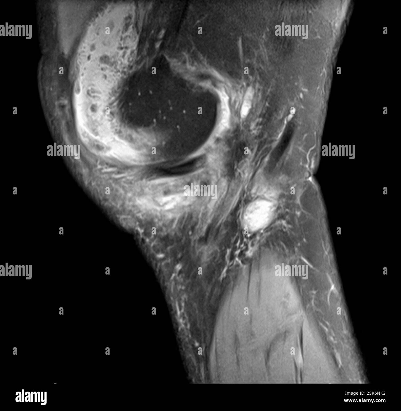 Infected knee joint. Sagittal magnetic resonance imaging (MRI) scan of ...