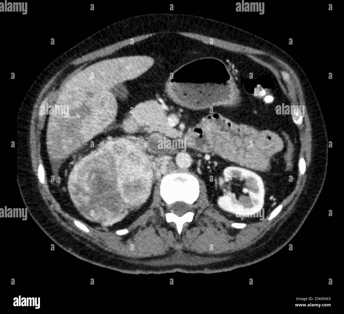 Kidney cancer. Axial computed tomography (CT) scan of the abdomen of a ...