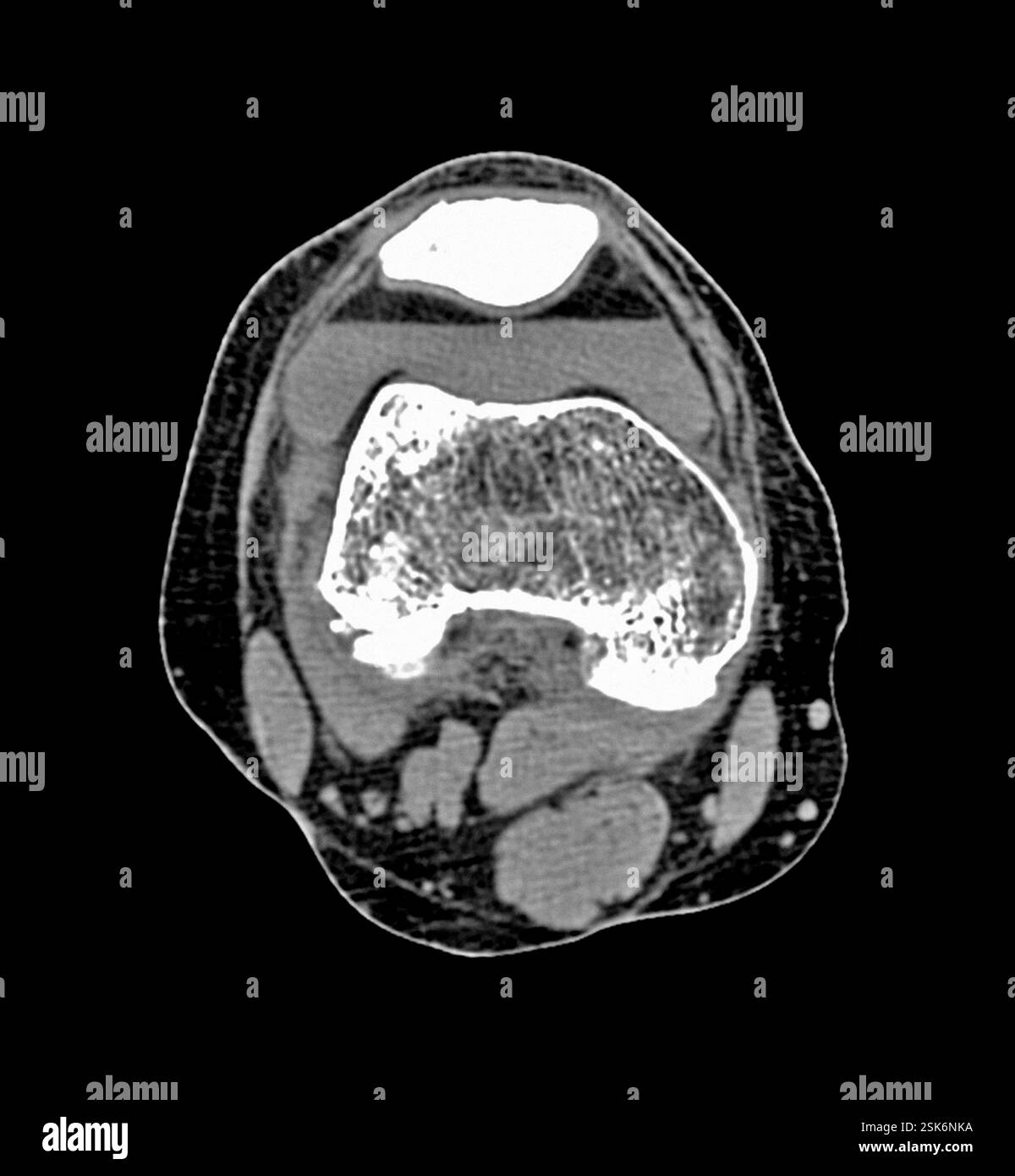 Hodgkin's lymphoma, CT scan Stock Photo - Alamy