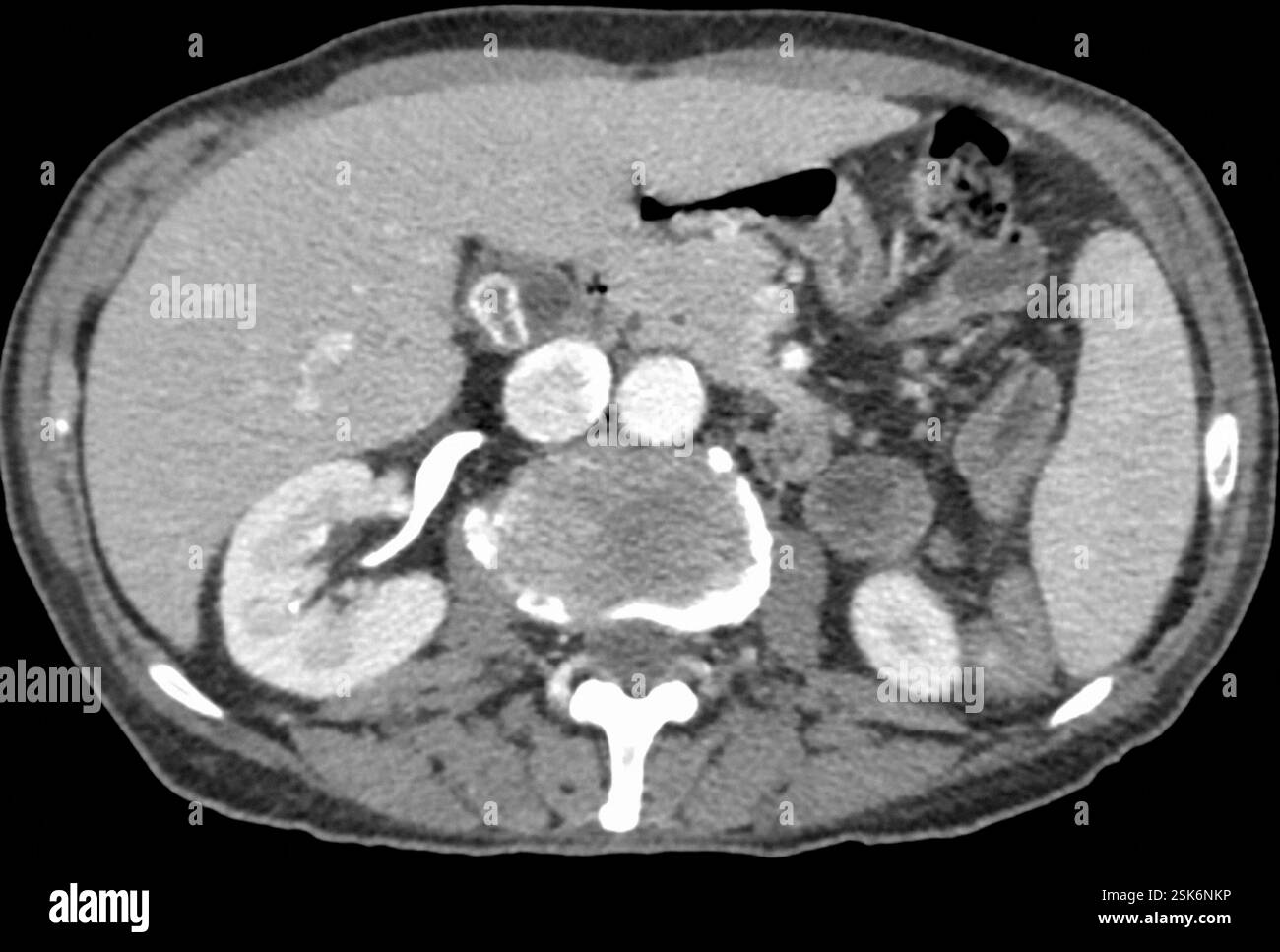 Gallstones. Axial computed tomography (CT) scan of the abdomen of a ...