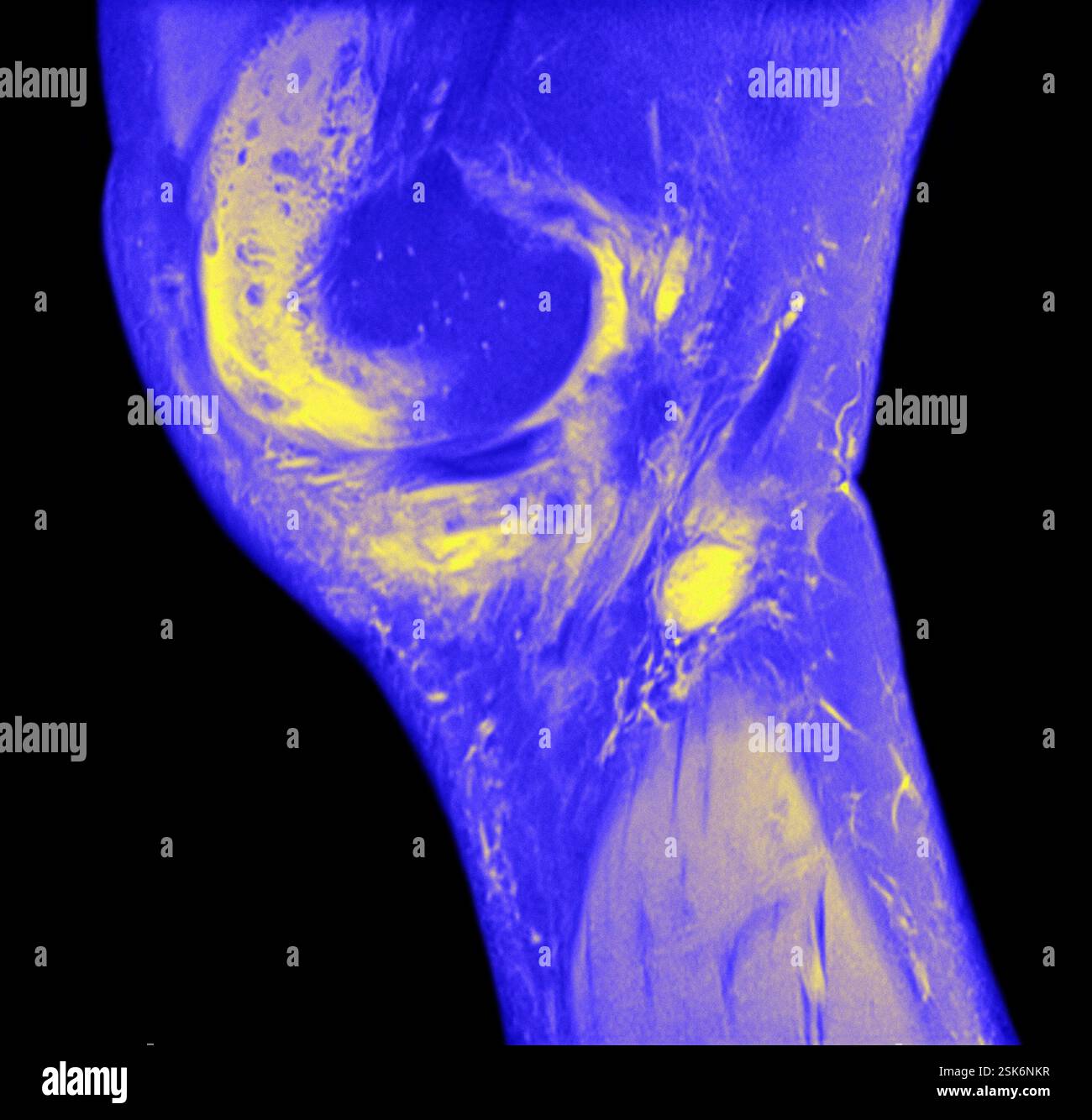 Infected knee joint. Coloured sagittal magnetic resonance imaging (MRI ...