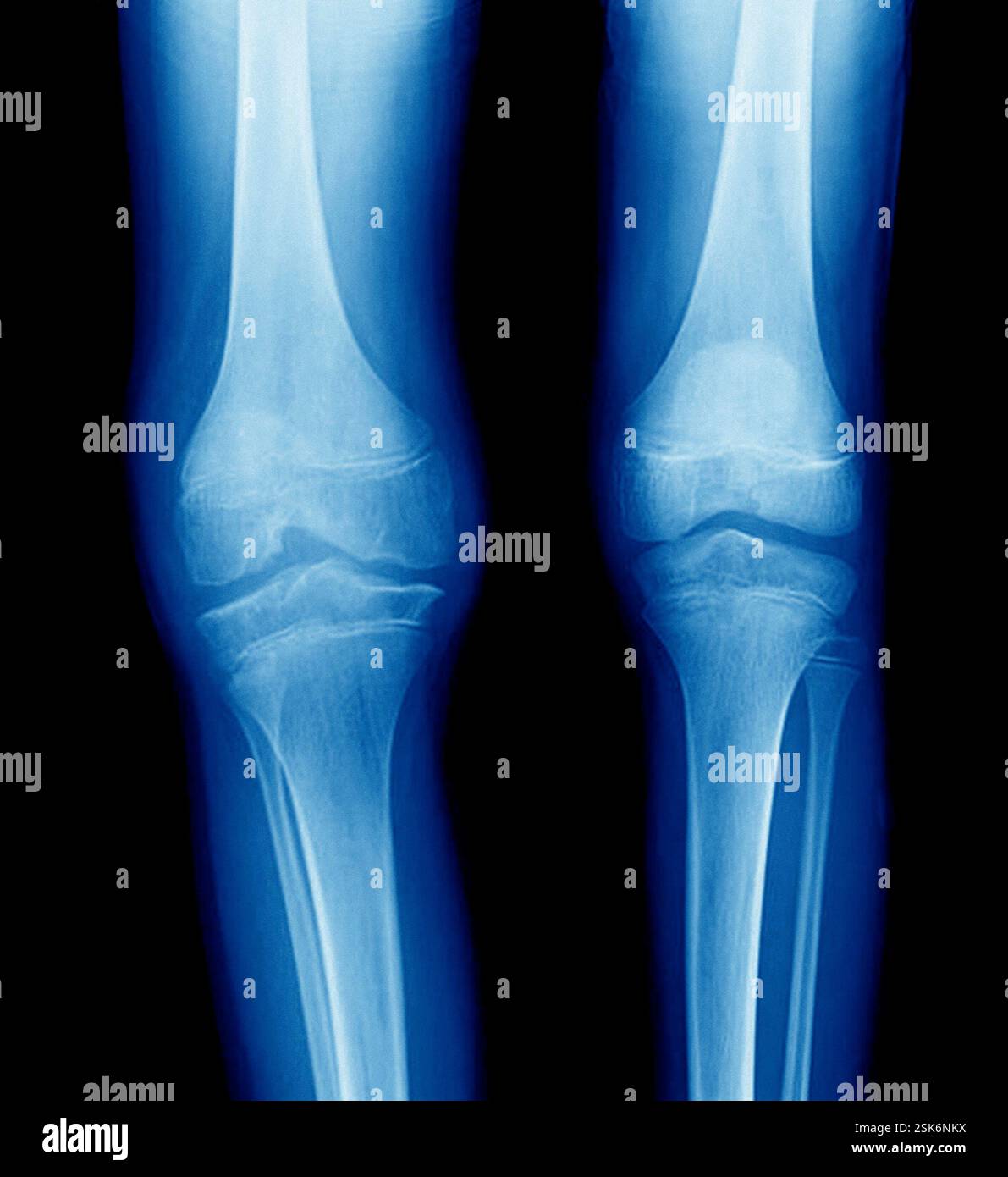 Infected knee joint. Coloured frontal X-ray of the knees of a patient ...
