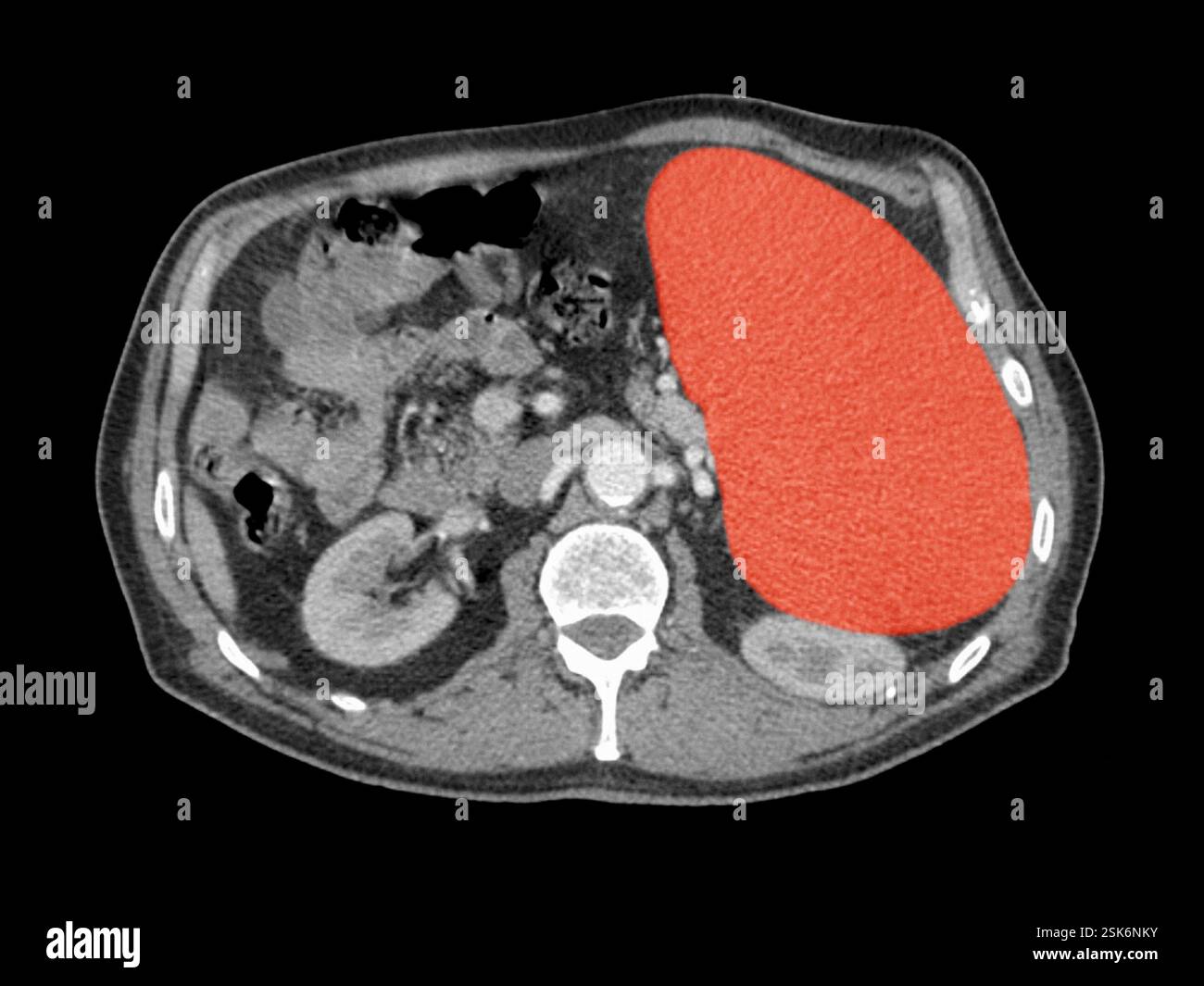 Splenomegaly. Coloured axial computed tomography (CT) scan of the ...