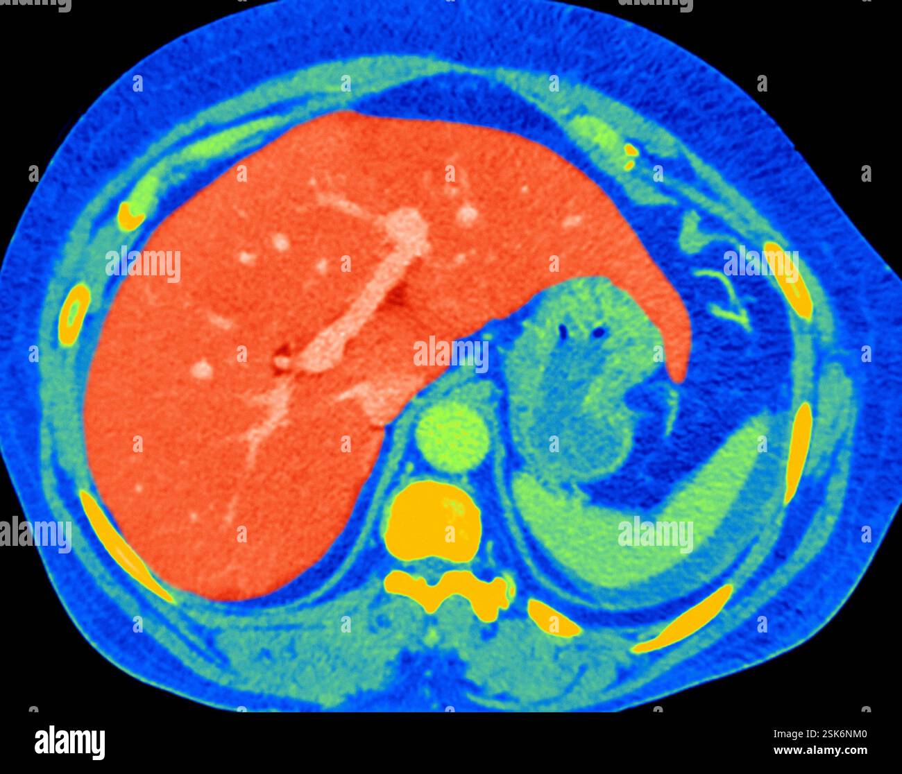 Hepatomegaly. Coloured axial computed tomography (CT) scan of the abdomen of a patient with ...