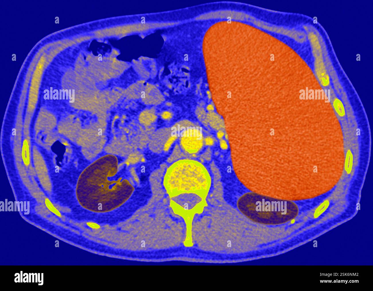 Splenomegaly. Coloured axial computed tomography (CT) scan of the ...