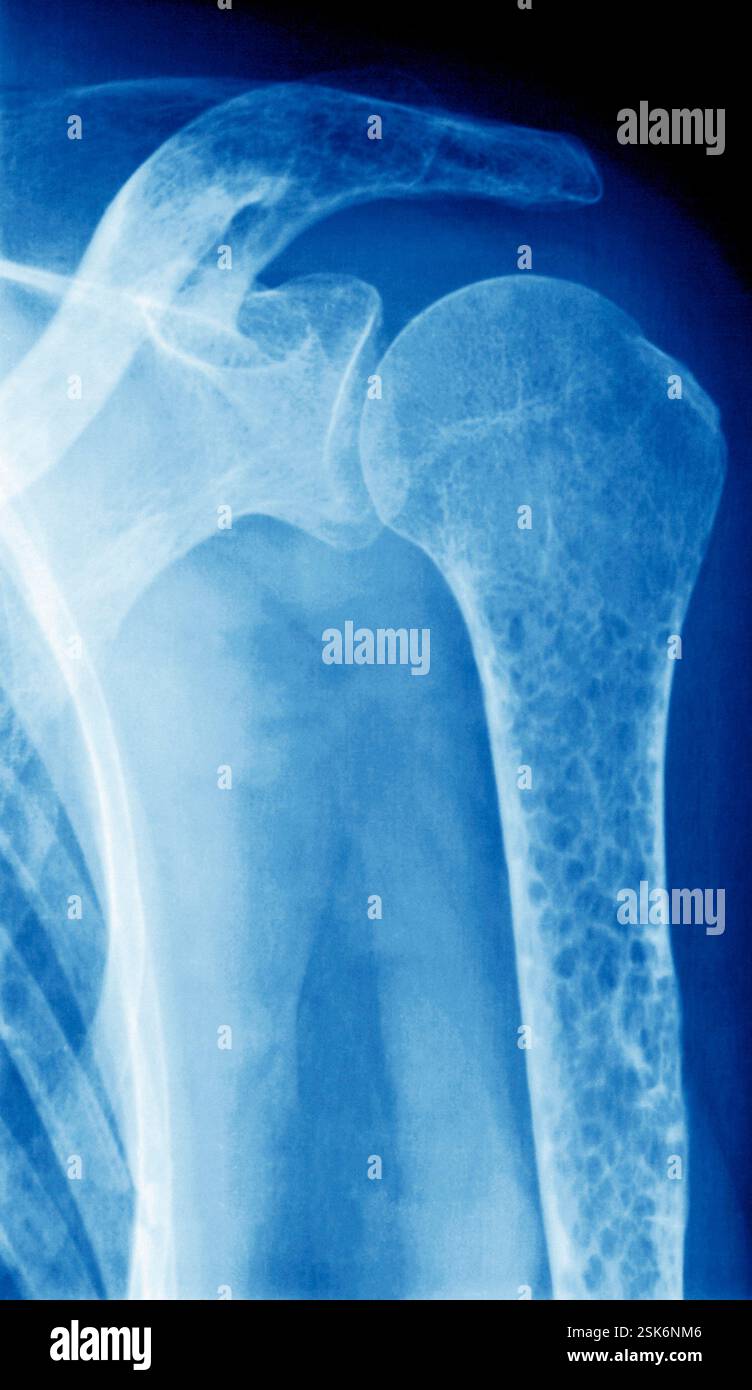 Bone marrow cancer. Coloured frontal X-ray of the shoulder and upper ...