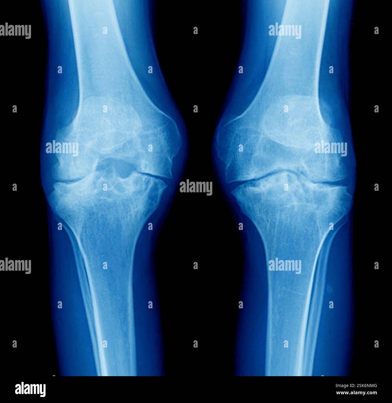 Infected knee joint. Coloured frontal X-ray of the knees of a patient ...