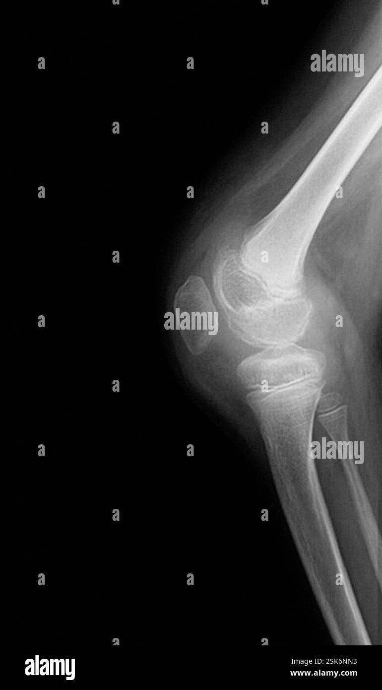 Infected knee joint. Sagittal X-ray of a patient's right knee with ...