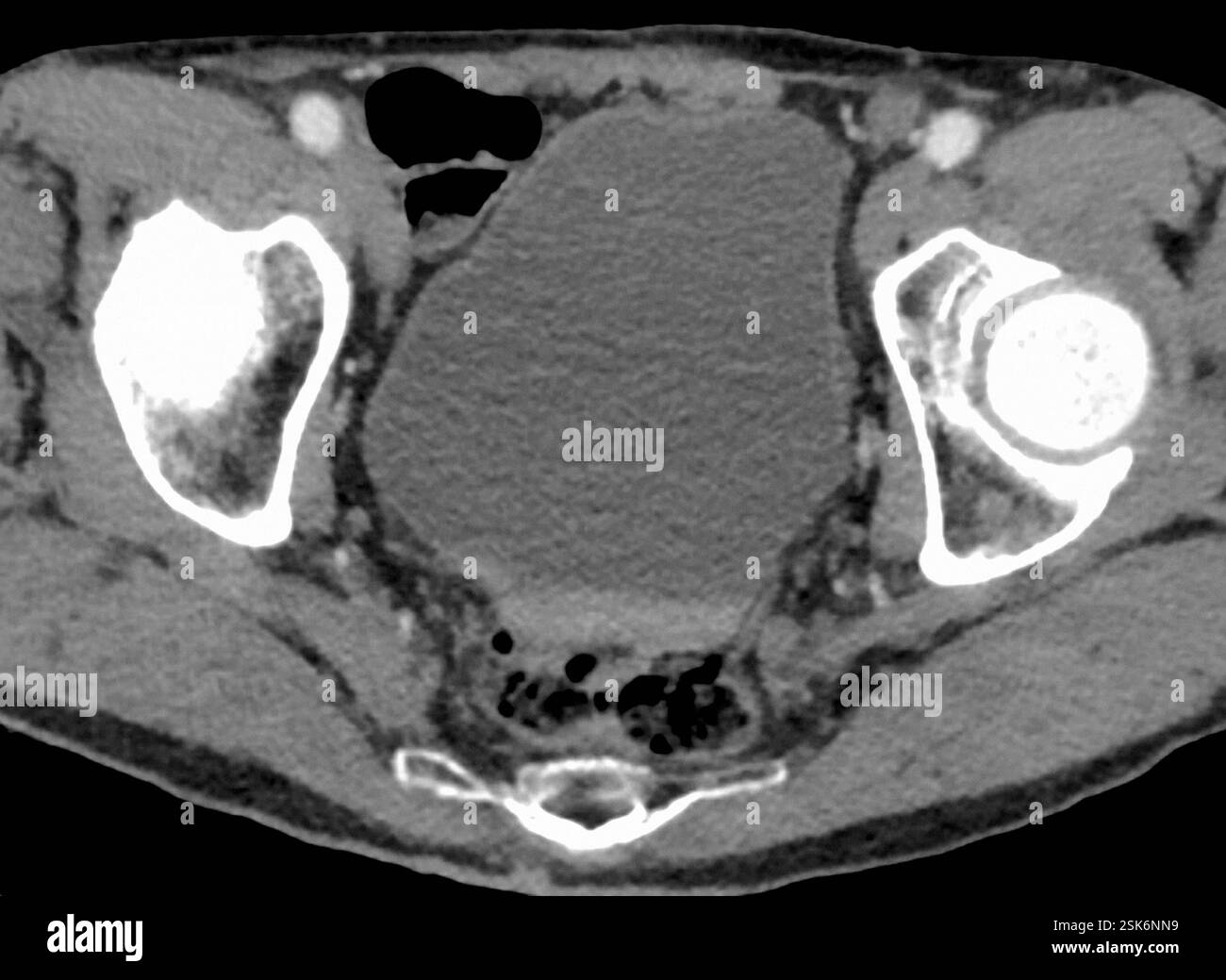 Bladder cancer. Axial computed tomography (CT) scan of the pelvis of a ...