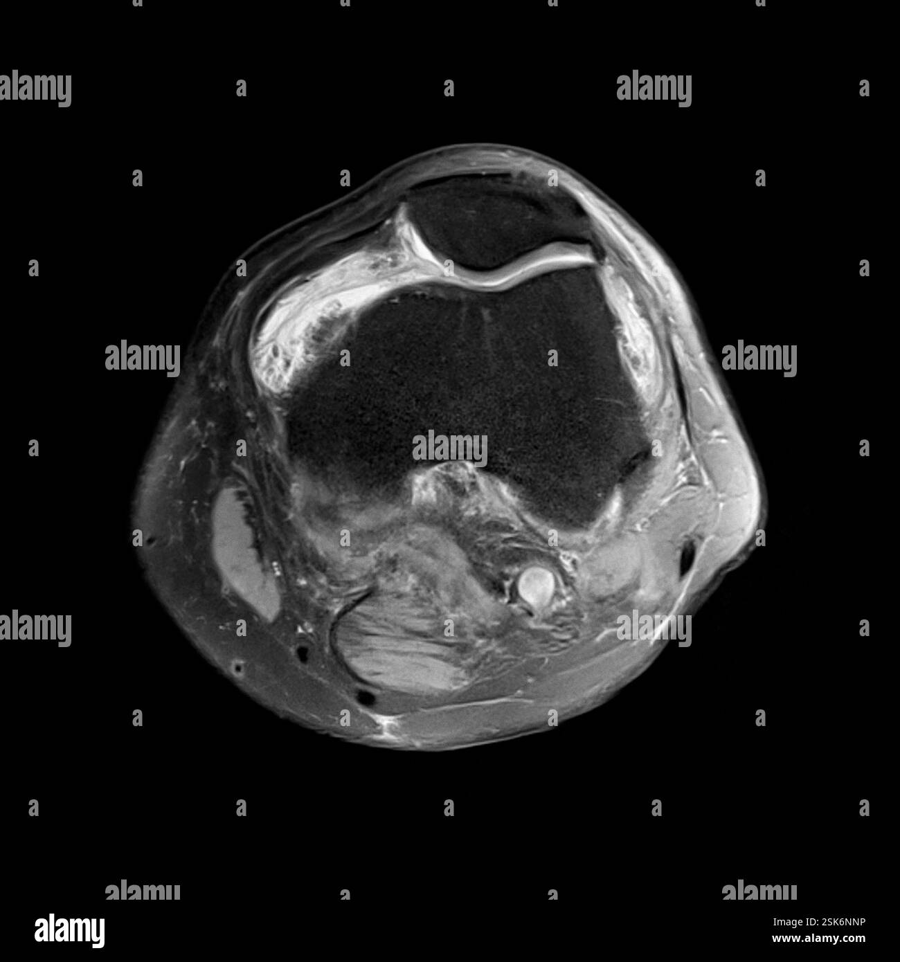 Infected knee joint. Axial magnetic resonance imaging (MRI) scan of the ...