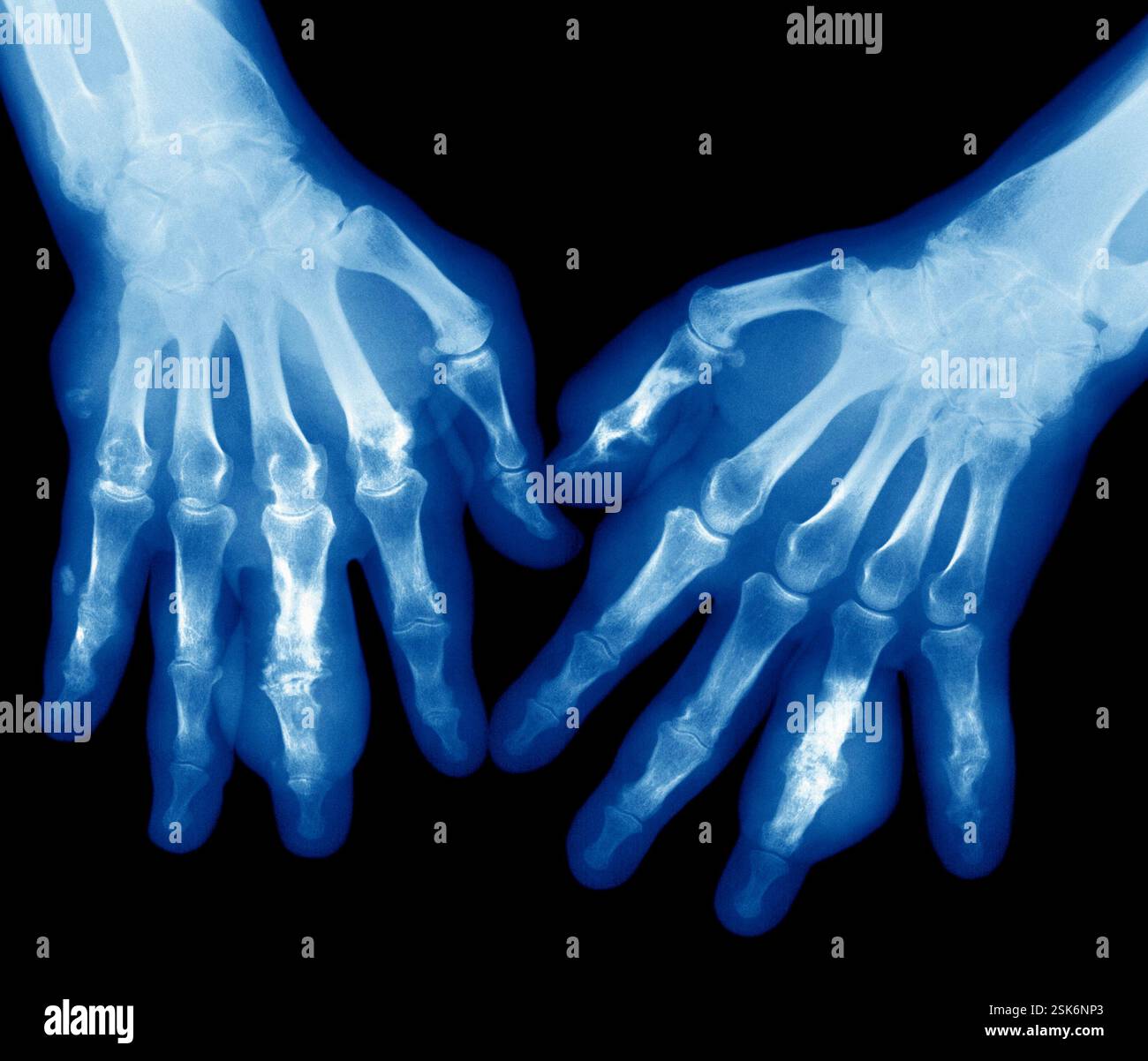 Coloured X-ray of the hands of a patient with gout in the joints of the ...