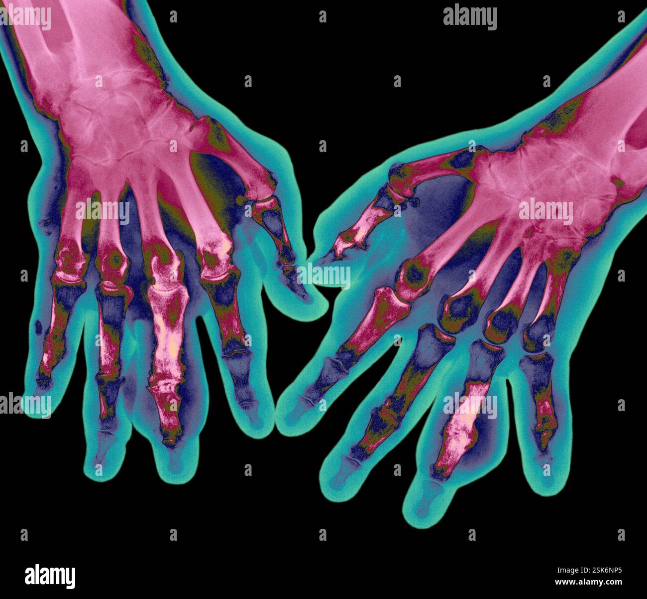 Coloured X-ray of the hands of a patient with gout in the joints of the ...