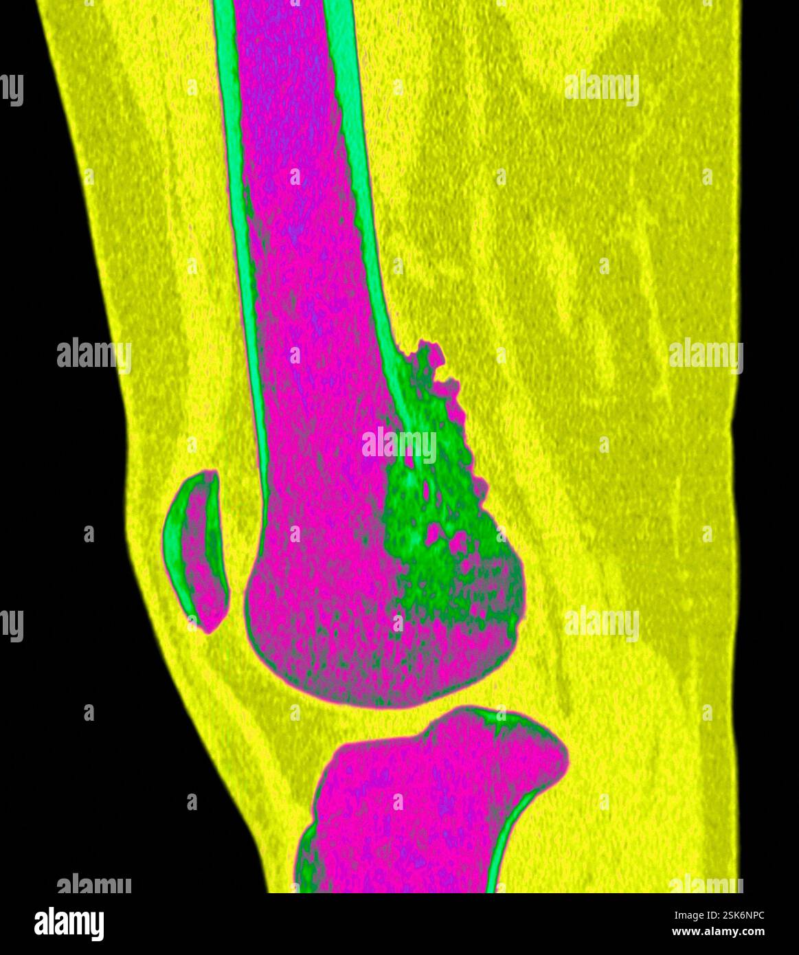 Bone cancer. Coloured lateral computed tomography (CT) scan of the knee ...
