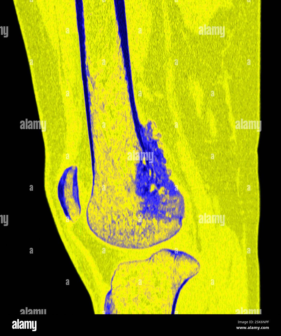Bone cancer. Coloured lateral computed tomography (CT) scan of the knee ...