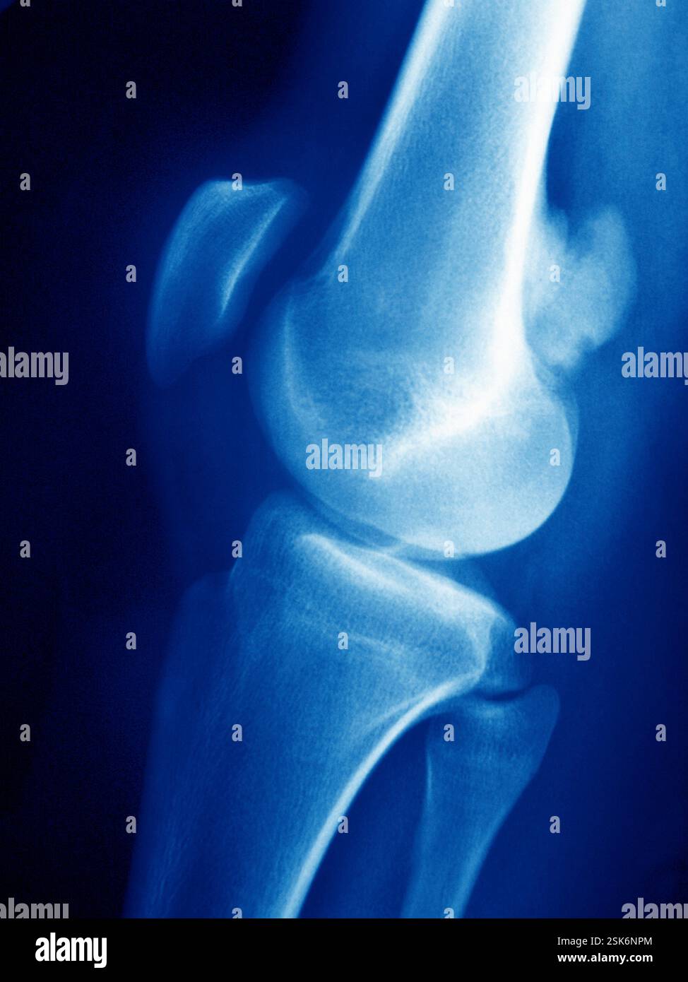 Bone cancer. Coloured lateral X-ray of the knee of a patient with a ...