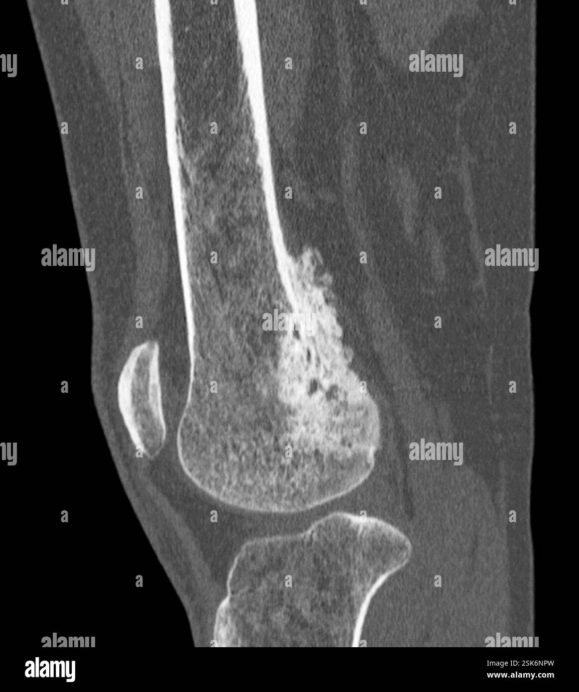 Bone cancer. Lateral computed tomography (CT) scan of the knee of a ...