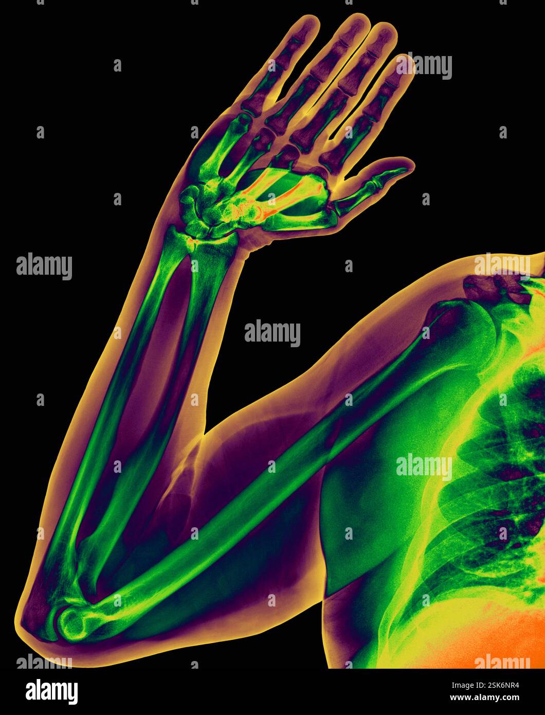 Healthy arm. Coloured frontal X-ray of a healthy patient's right arm ...