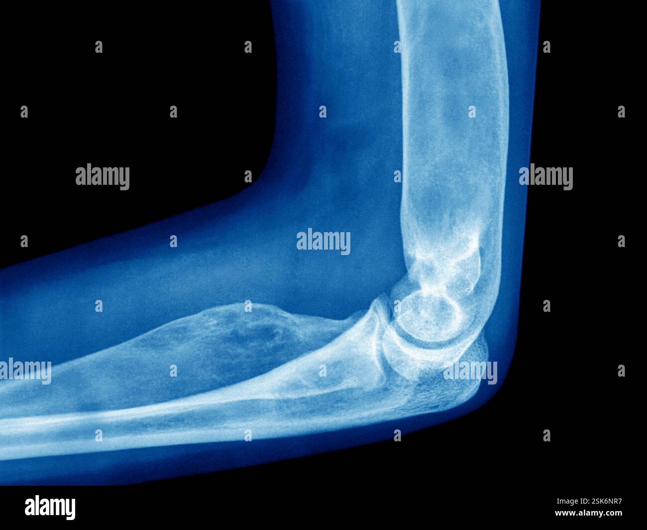 Fibrous dysplasia of the humerus (upper arm bone) and radius (forearm ...